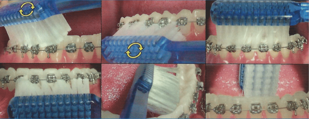 Brushing and Flossing Instructions for Braces at Smile Appeal Orthodontics