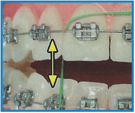 Brushing and Flossing Instructions for Braces at Smile Appeal Orthodontics