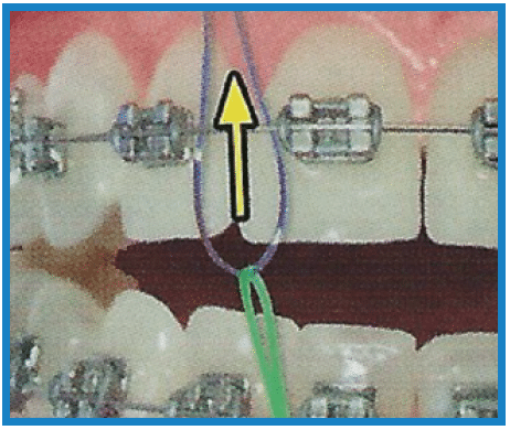 Brushing and Flossing Instructions for Braces at Smile Appeal Orthodontics